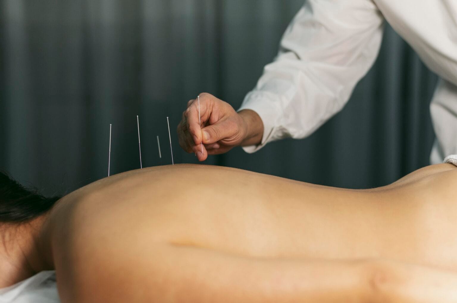 Acupuncture - All Care Physio
